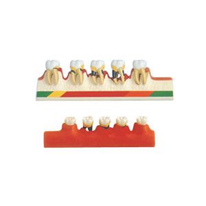 Periodontal disease classification model-Teeth Models